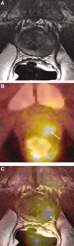 State of the art in oncologic imaging of Prostate. | Leaders in ...