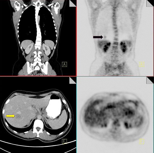 Causes and imaging features of false positives and false negatives on ...