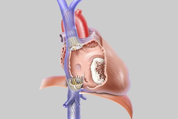 trivalve_transcatheter-bicaval-valves-system_650x450 | Leaders in ...